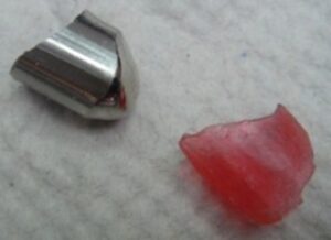 TELESCOPIC CROWNS – PDI Dental Direct